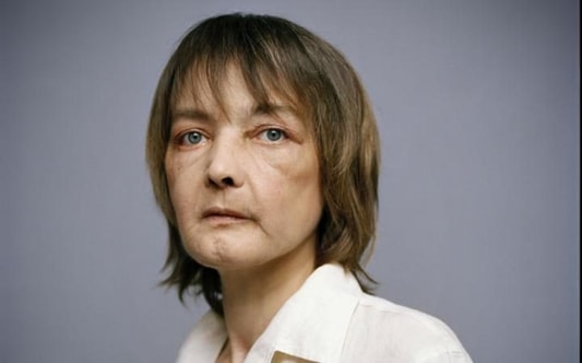 World's First Face Transplant Recipient Dies of Cancer - MTV Lebanon